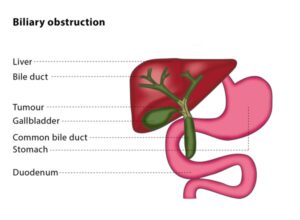 Biliary procedures – CIRSE