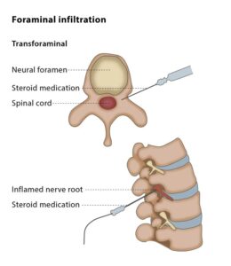 Infiltrations and guided injections – CIRSE