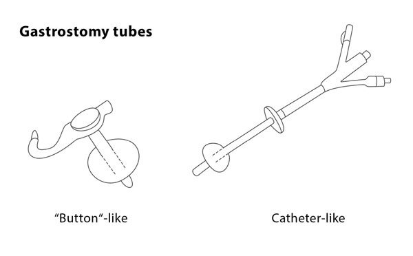 Gastrostomy – CIRSE