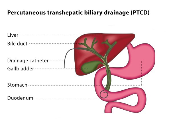 Biliary procedures – CIRSE
