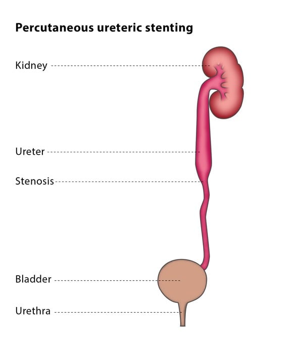 Ureteric Stenting Cirse