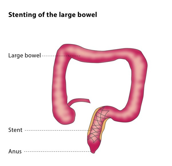 Gastrointestinal and oesophageal stenting – CIRSE
