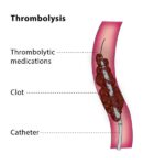 Thrombolysis – CIRSE