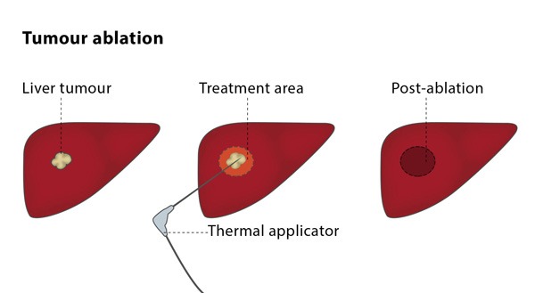 Ablation