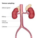 Venous sampling – CIRSE